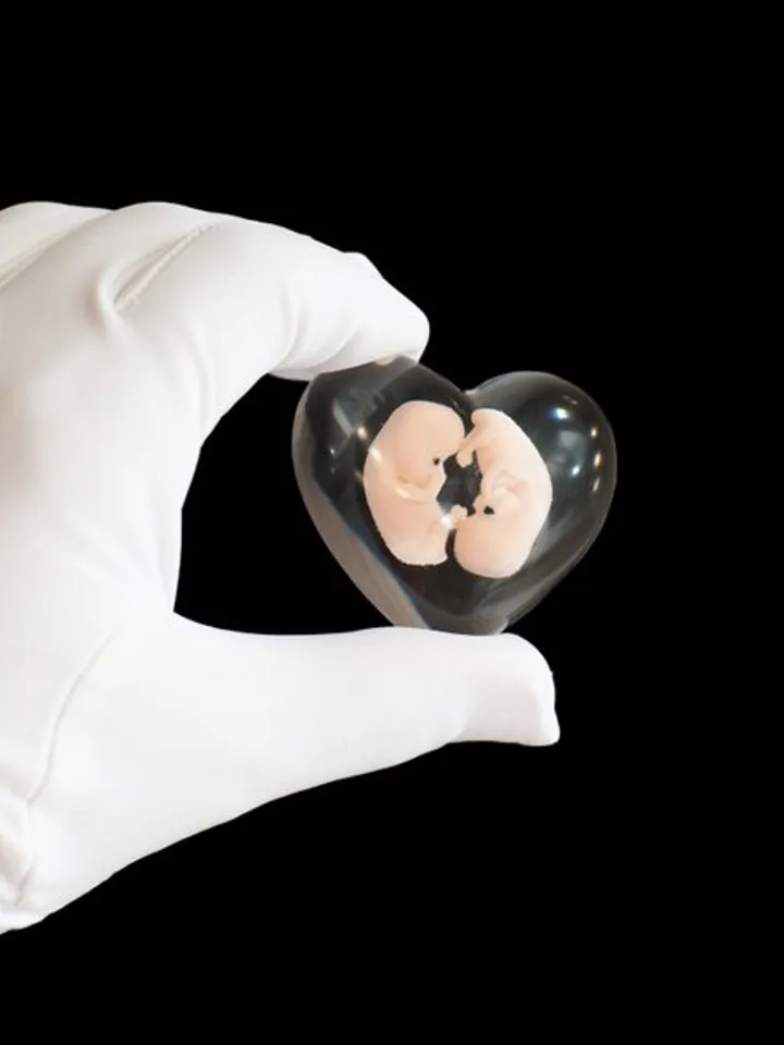 Twins Embryo 8 weeks cast in resin, 8 weeks pregnant, bereavement fetus ...