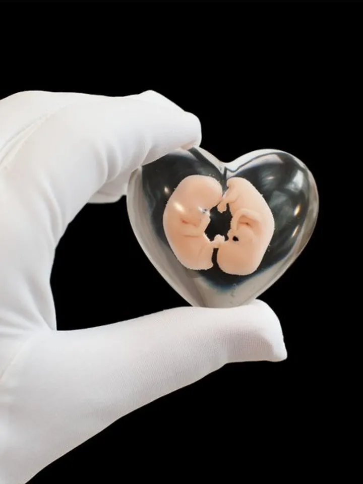 Twins Embryo 8 weeks cast in resin, 8 weeks pregnant, bereavement fetus ...